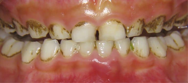 Pourquoi le tartre dentaire noir est-il si dangereux pour votre santé ...